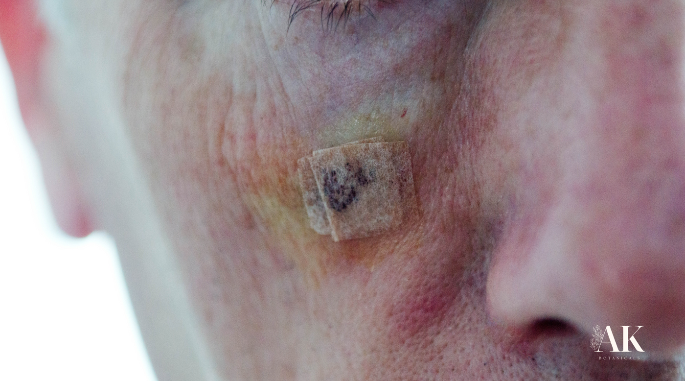 Actinic Keratosis vs. Seborrheic Keratosis: Understanding the Differen